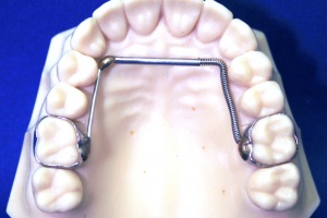 Expanders - Five Star Orthodontic