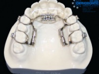 Distalizers - Five Star Orthodontic