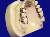 Distalizers - Five Star Orthodontic