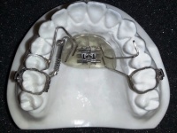 Distalizers - Five Star Orthodontic