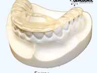 Splints - Five Star Orthodontic