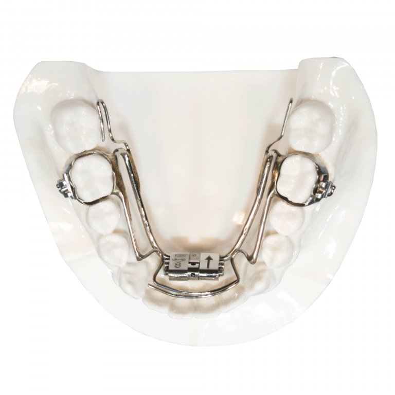 Expanders - Five Star Orthodontic