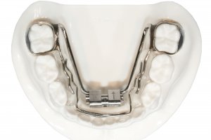Expanders - Five Star Orthodontic