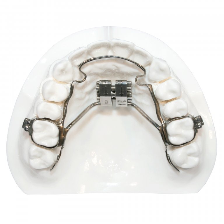 Expanders - Five Star Orthodontic