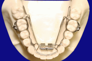Expanders - Five Star Orthodontic