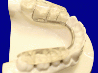 Splints - Five Star Orthodontic