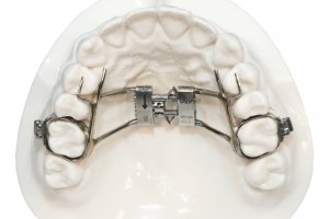 Expanders - Five Star Orthodontic