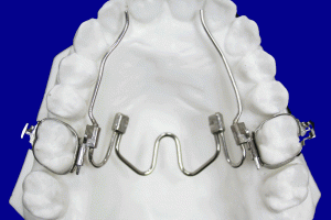 Expanders - Five Star Orthodontic