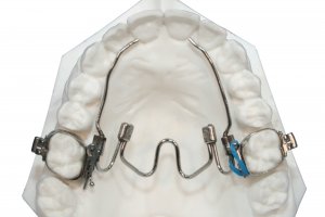 Expanders - Five Star Orthodontic