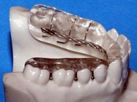 Splints - Five Star Orthodontic