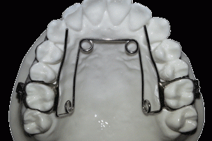 Expanders - Five Star Orthodontic