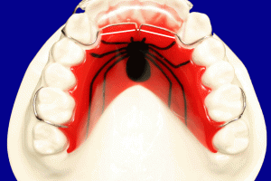 Retainers - Five Star Orthodontic