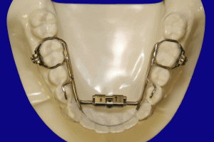 Expanders - Five Star Orthodontic