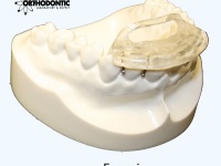 Splints - Five Star Orthodontic