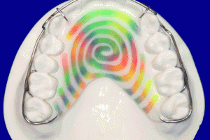 Retainers - Five Star Orthodontic