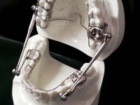 Appliances - Five Star Orthodontic