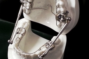 Class II Appliances - Five Star Orthodontic