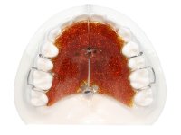 Expanders - Five Star Orthodontic