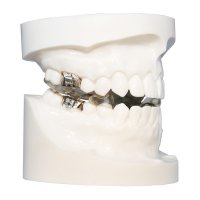 Class II Appliances | Five Star Orthodontic