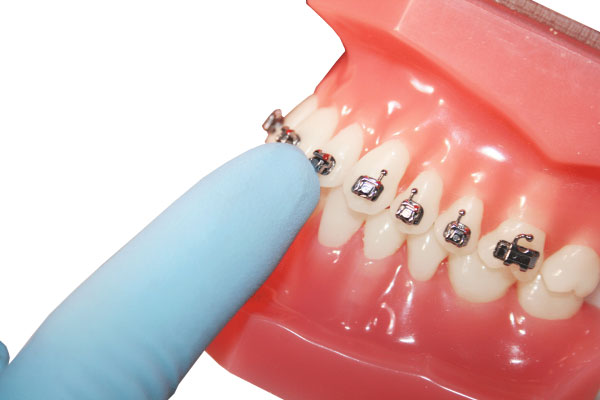 Five Star’s Newest Bracket: The Nova SL | Five Star Orthodontic