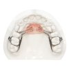 Distalizers - Five Star Orthodontic