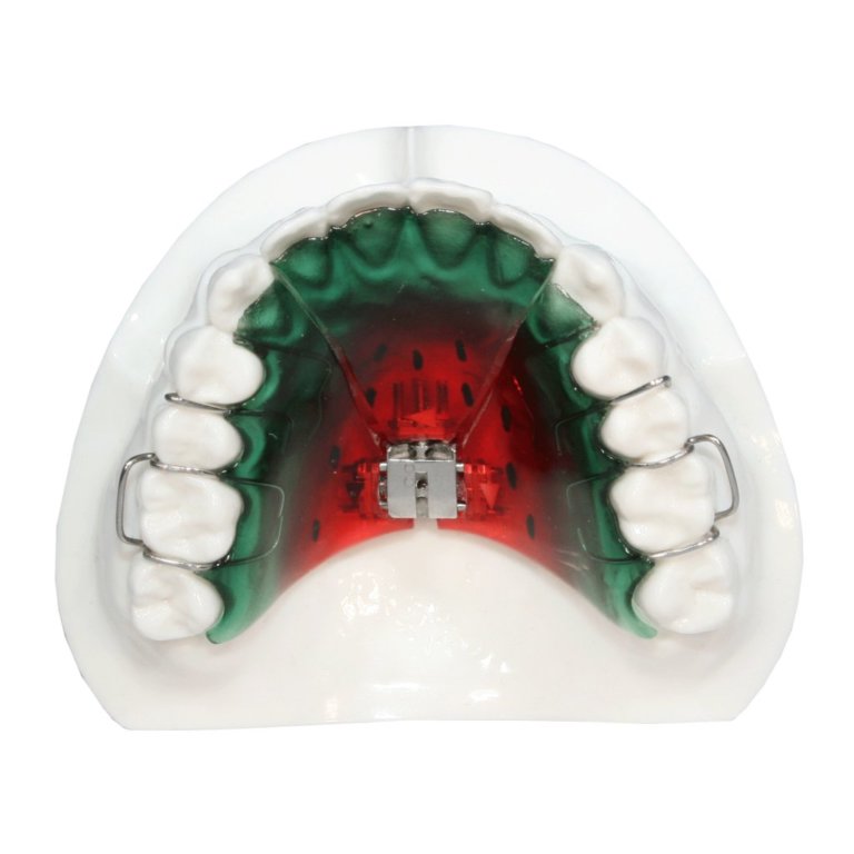 Expanders - Five Star Orthodontic