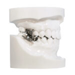 Class II Appliances - Fivestar Ortho