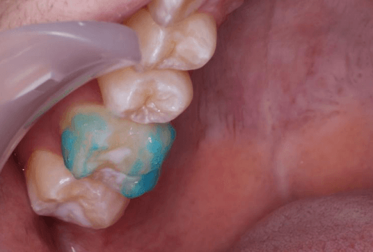 Revolutionizing Orthodontics with 3D Printed Bands - Fivestar Ortho