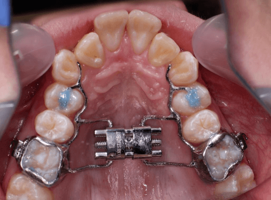 Revolutionizing Orthodontics with 3D Printed Bands - Fivestar Ortho