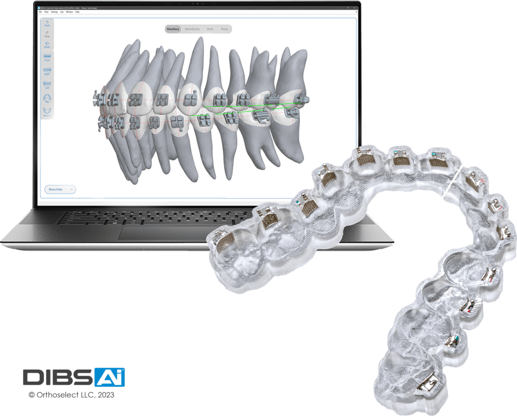 The Evolution of Bracket Bonding - Fivestar Ortho