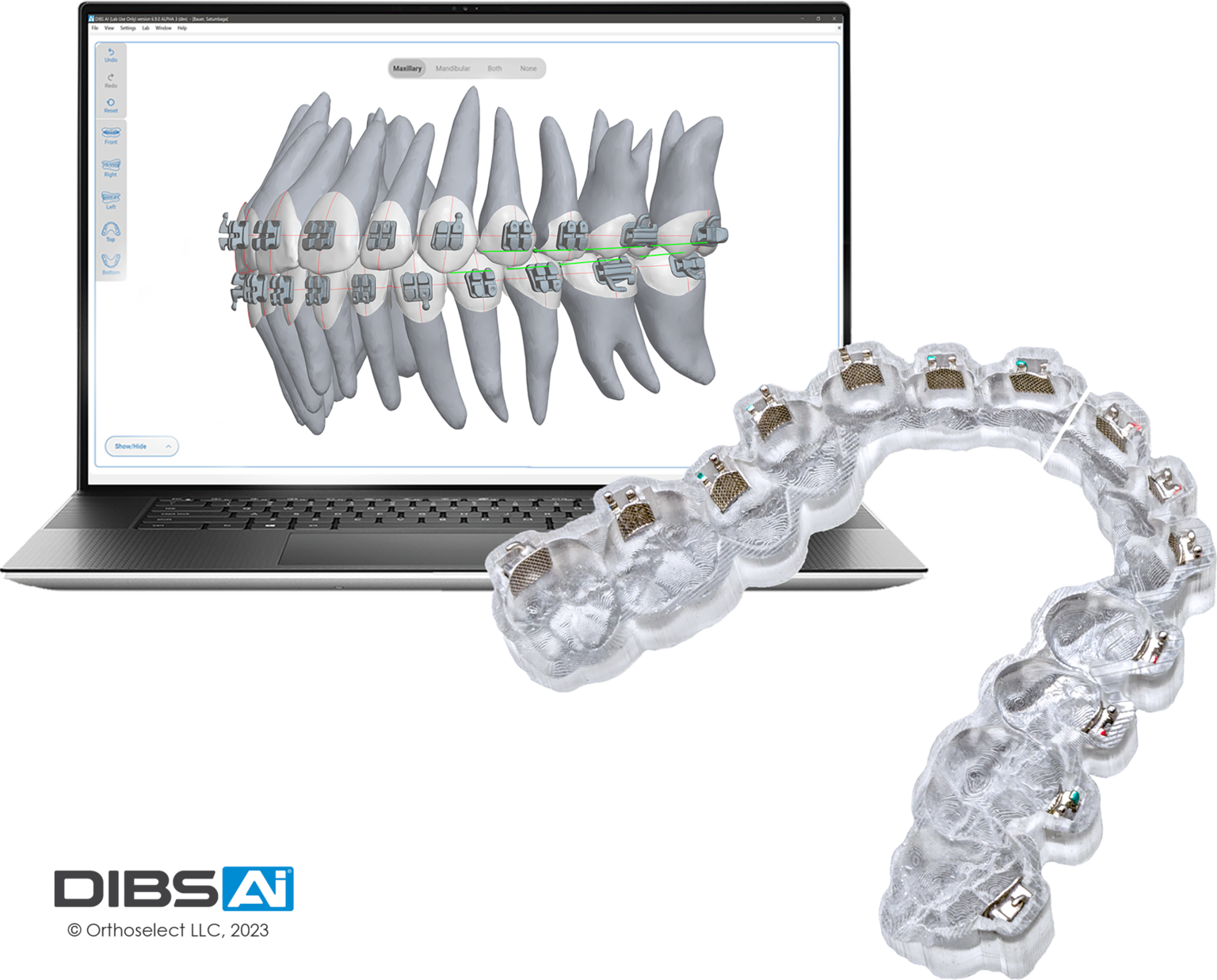 The Evolution of Bracket Bonding - Fivestar Ortho