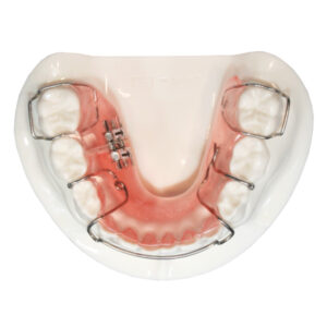 Distalizers - Fivestar Ortho