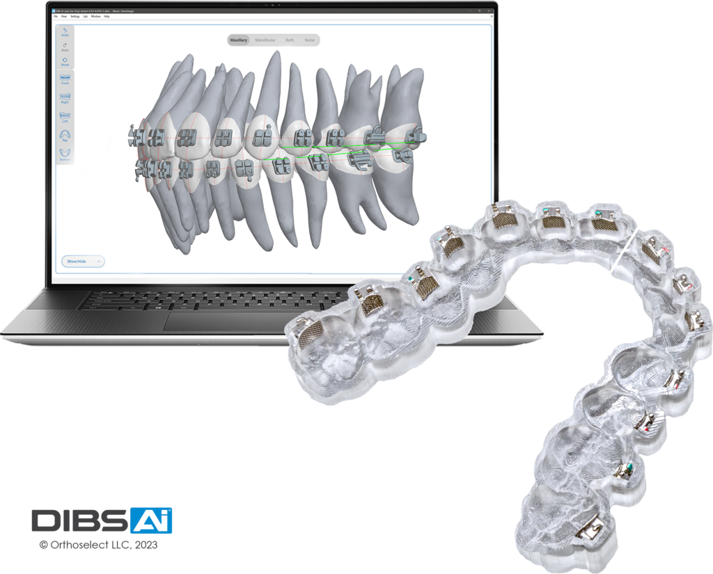 Revolutionize Your Orthodontic Treatment with Digital Indirect Bonding ...