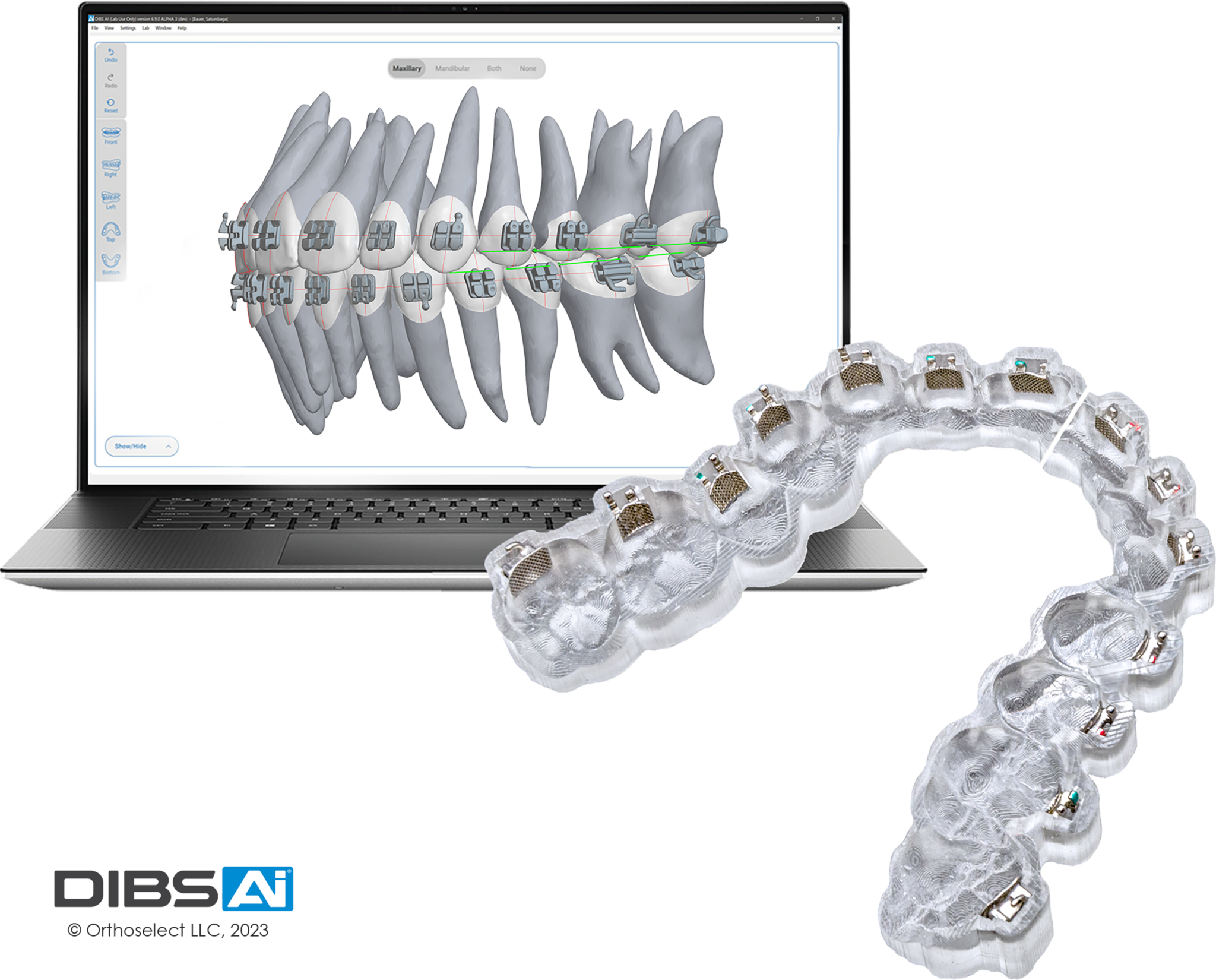 Digital Indirect Bonding - Fivestar Ortho